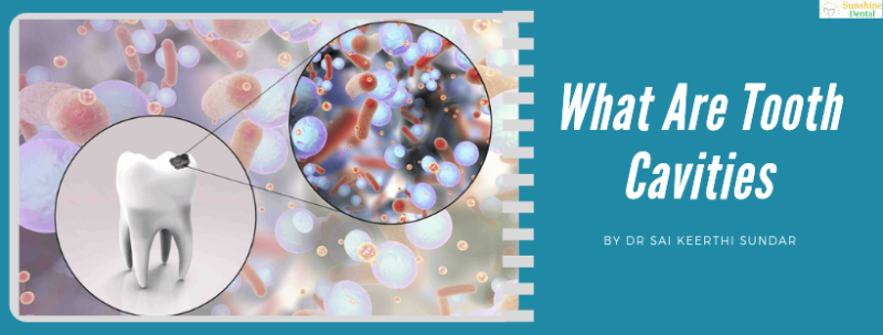 What are Tooth Cavities? | Orthodontist In Whitefield | Sunshine Dental